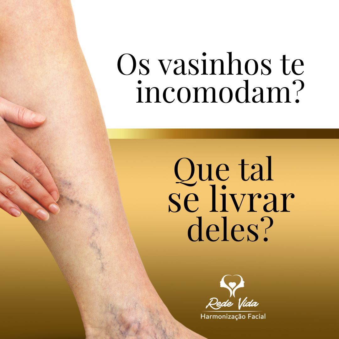 Tratamento de Vasinhos - Rede Vida